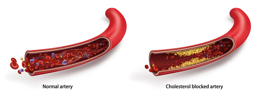 Coronary Angioplasty and Stenting - Capital Heart Centre