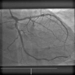 Coronary Angioplasty and Stenting - Capital Heart Centre