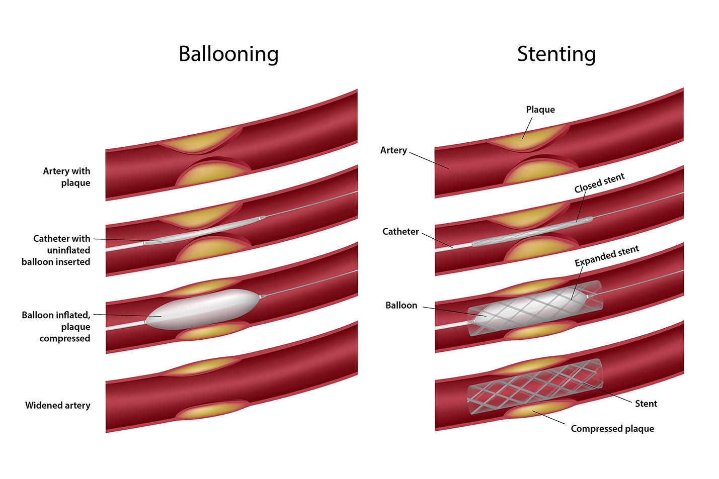 Coronary Angioplasty and Stenting - Capital Heart Centre