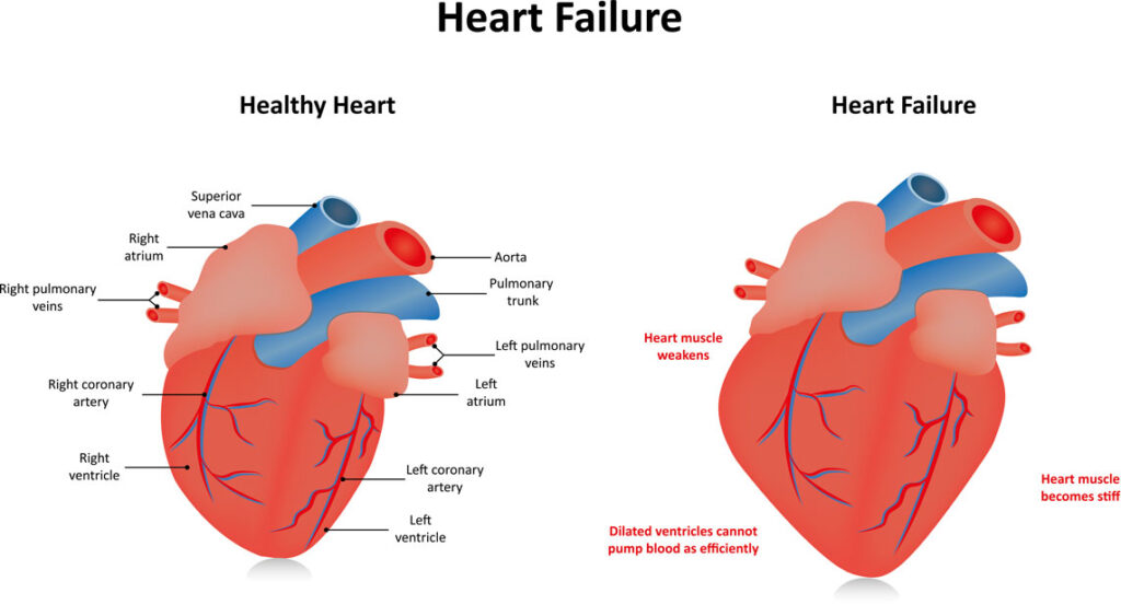 Heart Failure - Capital Heart Centre