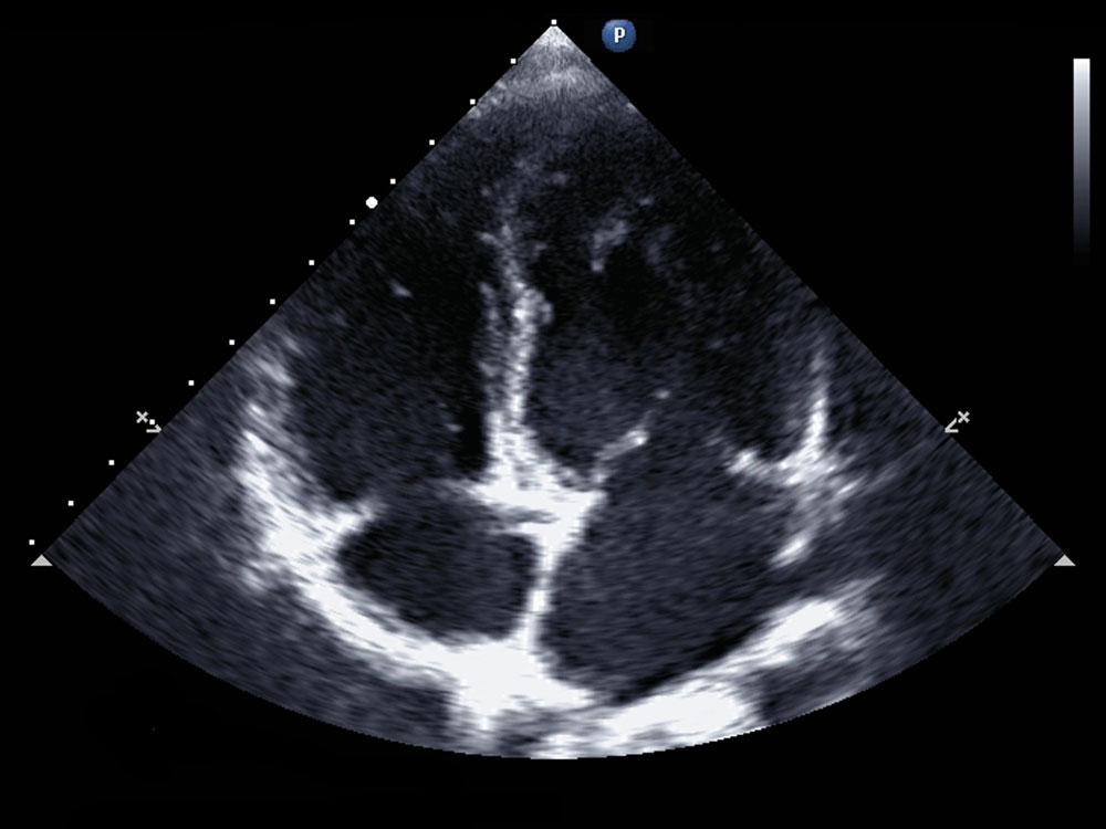 Transthoracic Echocardiography (TTE) - Capital Heart Centre
