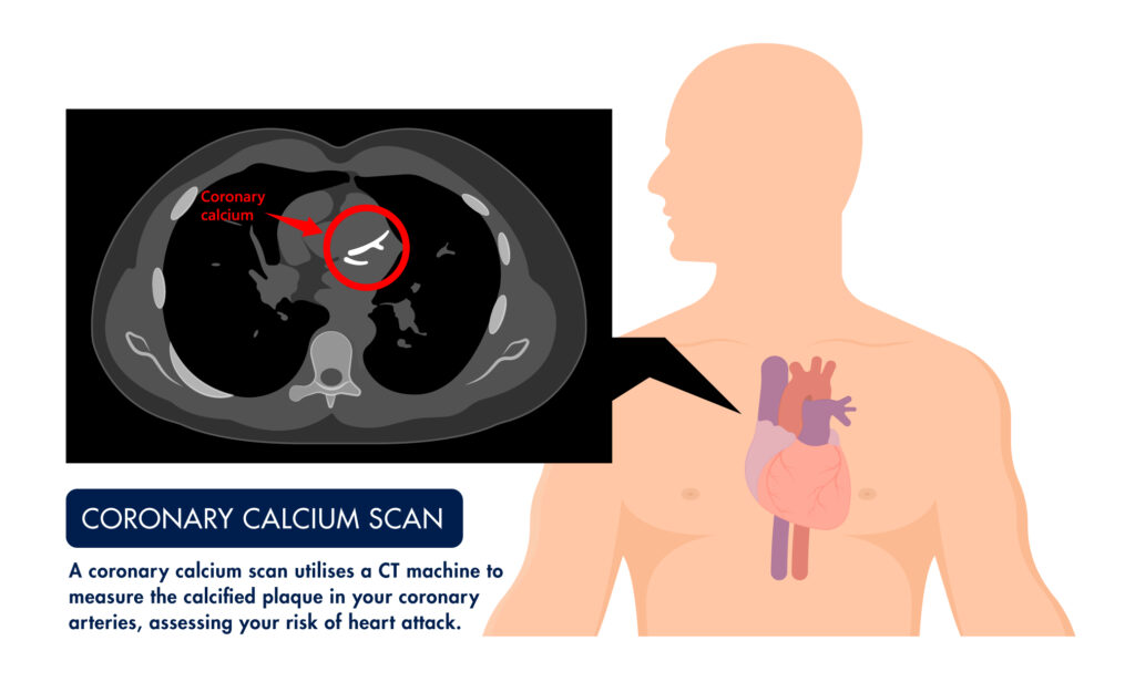 Coronary Calcium Score - Capital Heart Centre