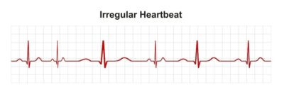 What Does An Abnormal ECG Mean? - Capital Heart Centre
