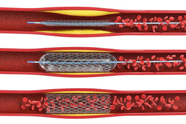 Recovery After Coronary Angioplasty: Tips for Healing and Rehabilitation